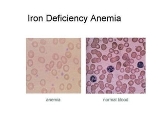 Iron Deficiency Anemia Slide