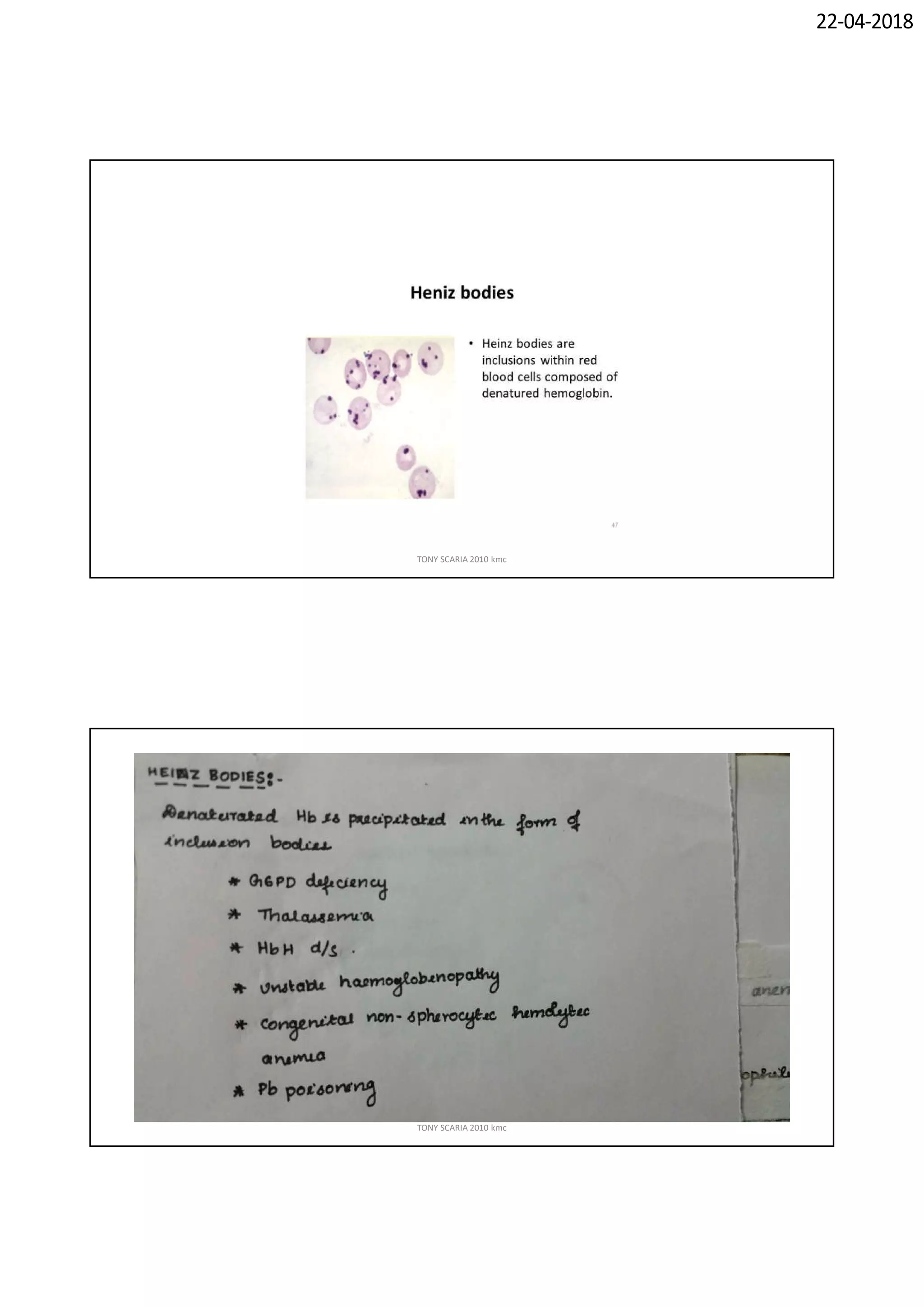 Hematology revision notes pathology | PDF