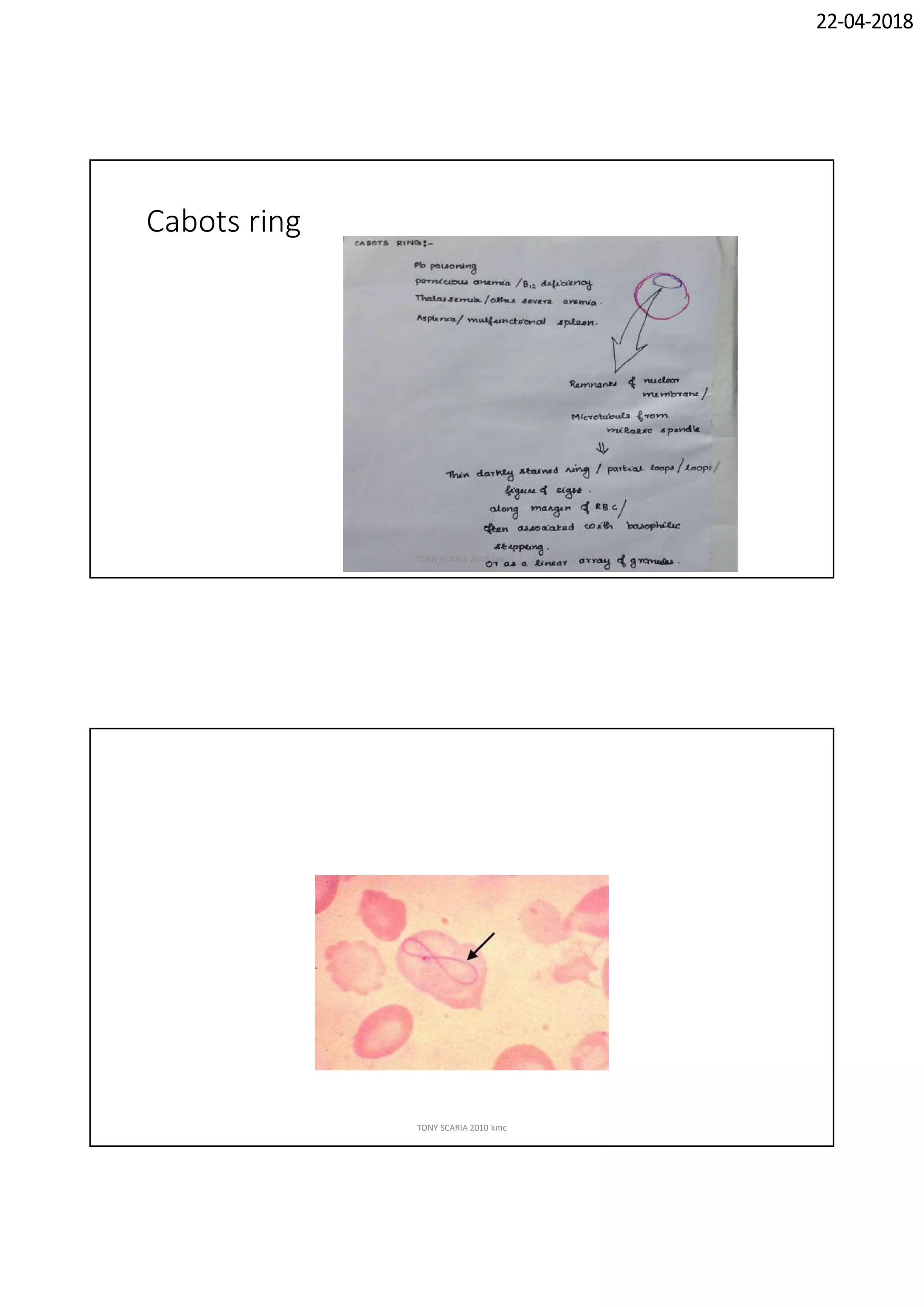 Hematology revision notes pathology | PDF
