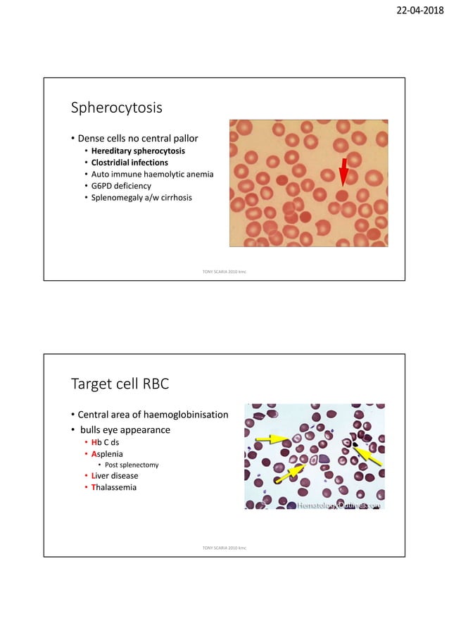 Hematology revision notes pathology | PDF