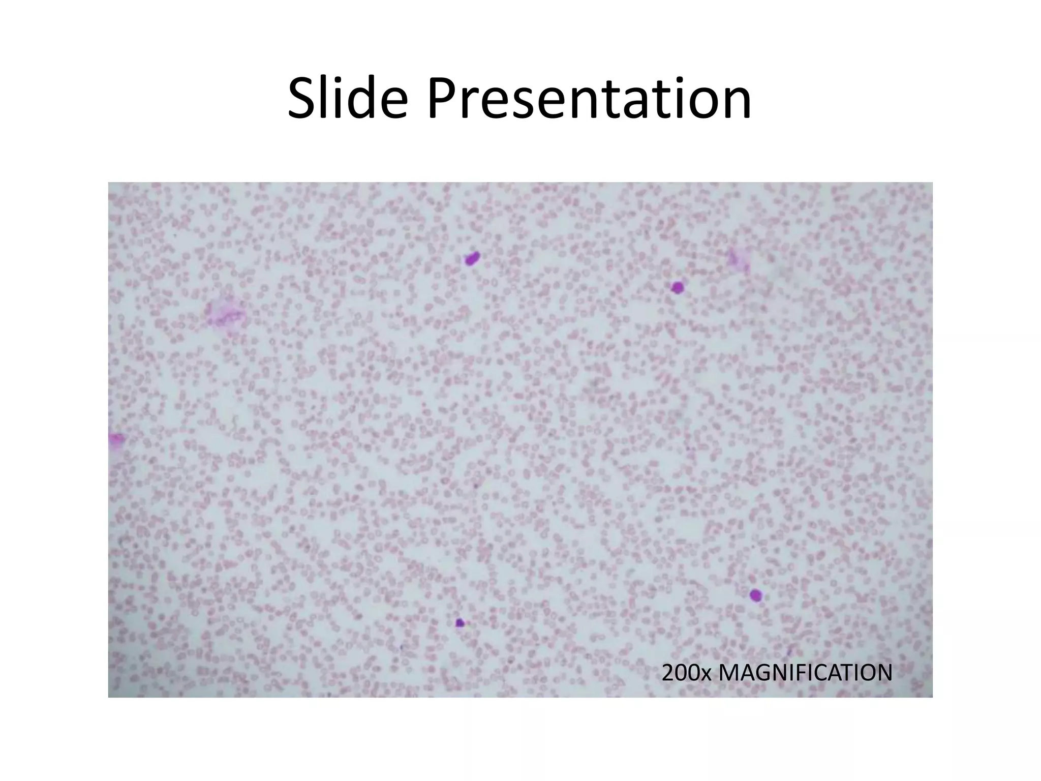 Hematology slide/ Pediatric leukemia | PPTX