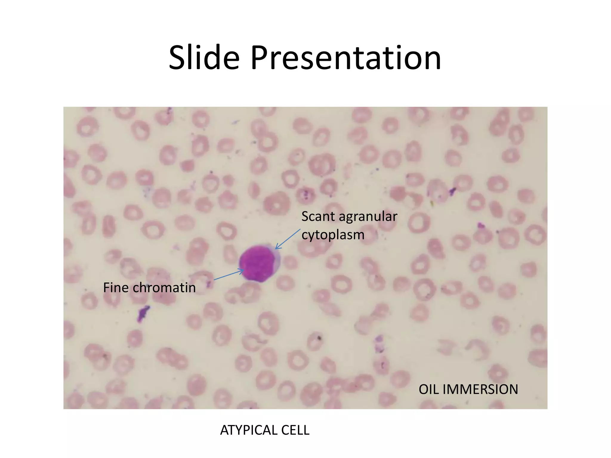Hematology slide/ Pediatric leukemia | PPTX