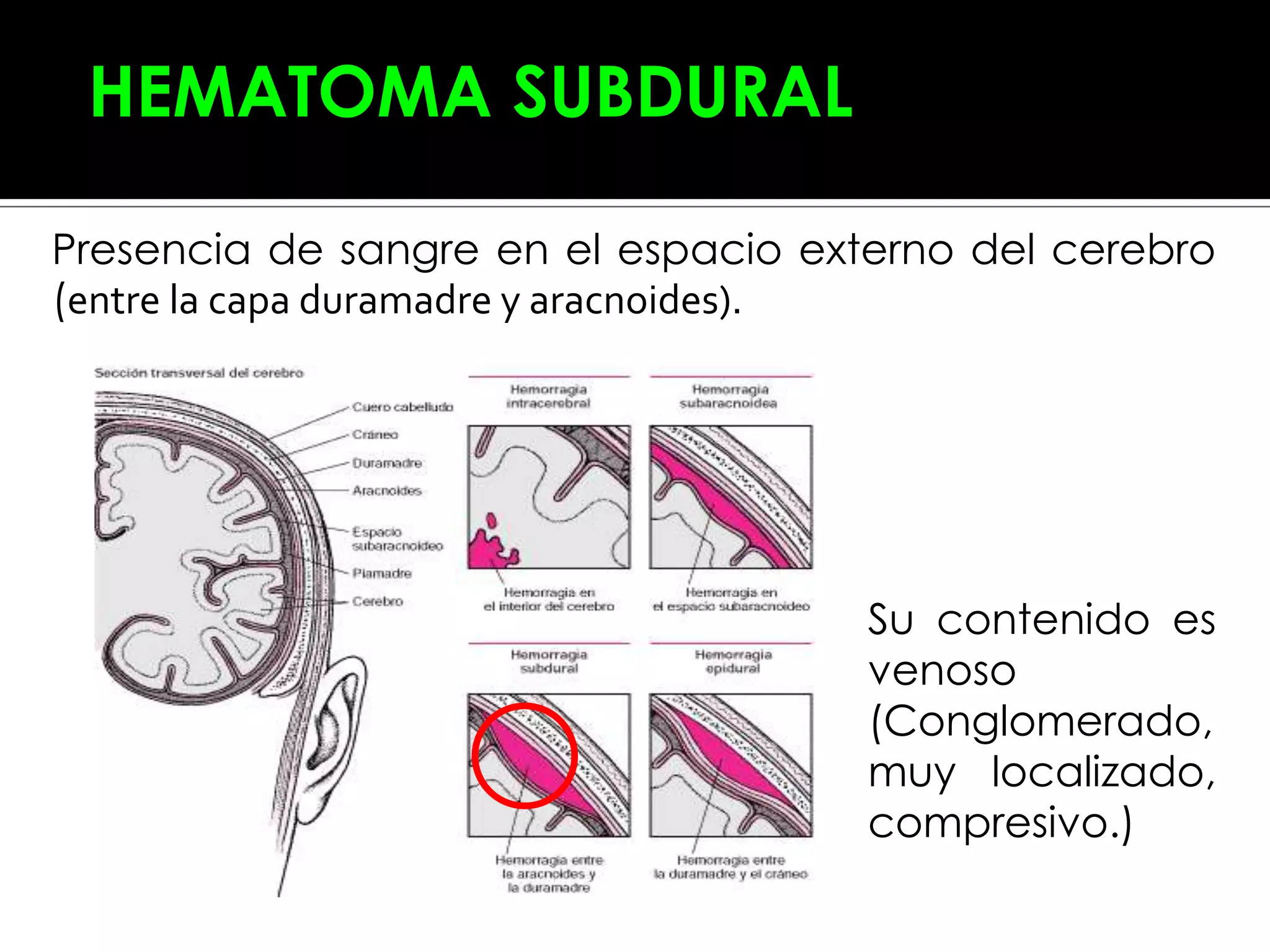 Hematoma Subdural y Hemorragia Sub aracnoidea | PPT