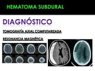 Hematoma Subdural y Hemorragia Sub aracnoidea | PPTX