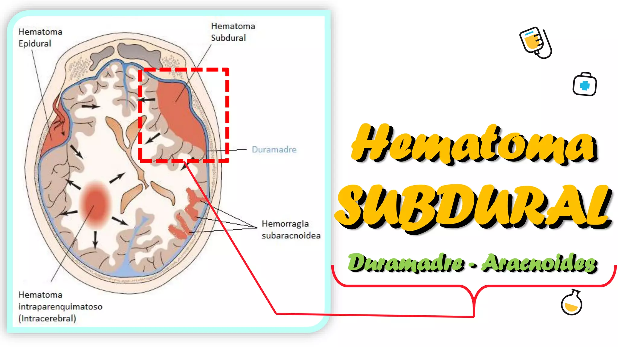 Hematoma epidural subdural y parenquimal lida | PDF