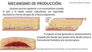 Hematoma Morel Lavallee.pptx