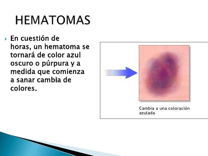 Hematomas