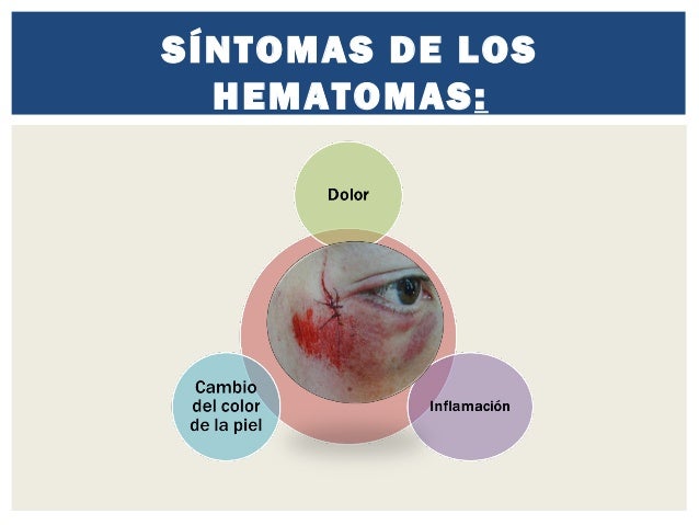 Causas comunes de hematomas inexplicados | signos de hematoma en sangre ...