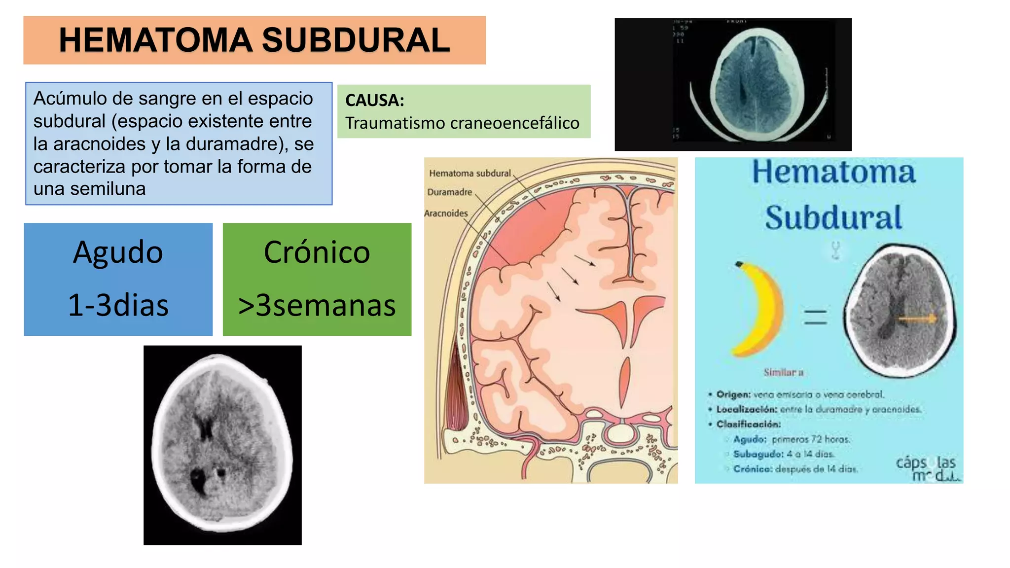 hematoma subdural agudo y cronico (1).pdf