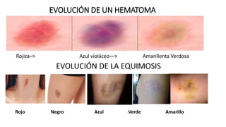 Hematoma y equimosis | PPT