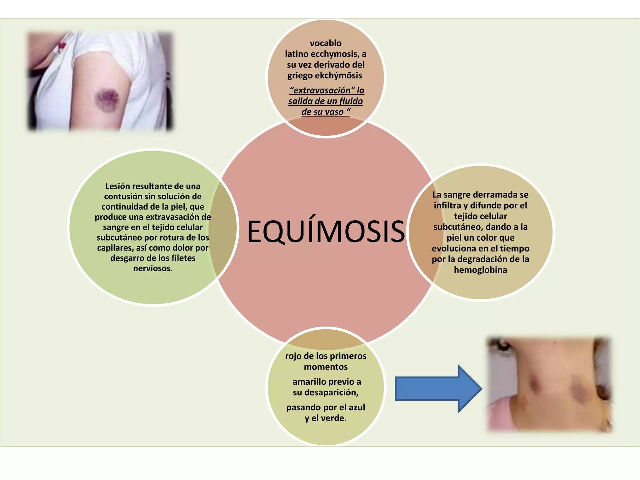 Hematoma y equimosis realizado por: Hernan campos | PPTX