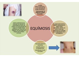 Hematoma y equimosis realizado por: Hernan campos | PPTX