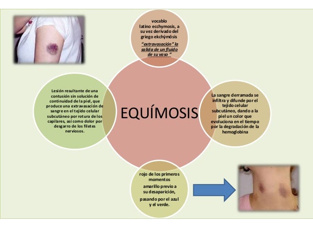 Hematoma y equimosis realizado por: Hernan campos