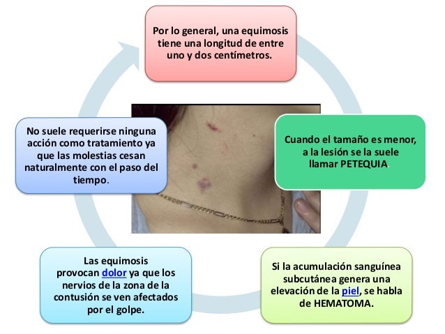 Equimosis O Hematoma