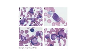 HEMATOPATHOLOGY CASES (1).pptx follicular mantle leukemia | PPT
