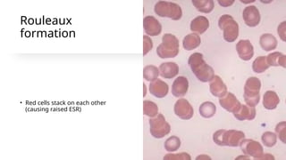 HEMATOPATHOLOGY CASES (1).pptx follicular mantle leukemia | PPTX