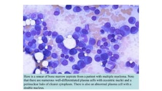 HEMATOPATHOLOGY CASES (1).pptx follicular mantle leukemia | PPT