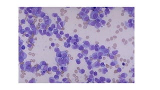 HEMATOPATHOLOGY CASES (1).pptx follicular mantle leukemia | PPT