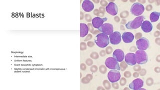 HEMATOPATHOLOGY CASES (1).pptx follicular mantle leukemia | PPT