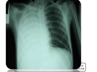 Hematothorakss.pptx