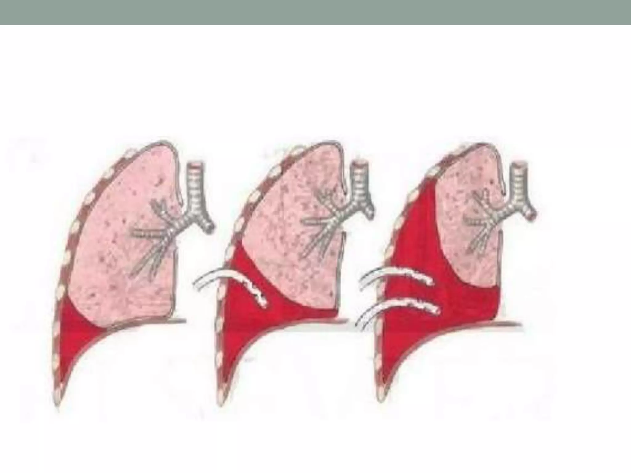 Hematothorax Pptx