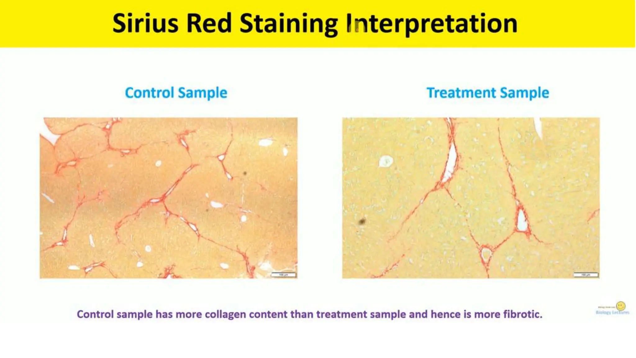 Histopathological staining techniques used in liver diseases | PPTX