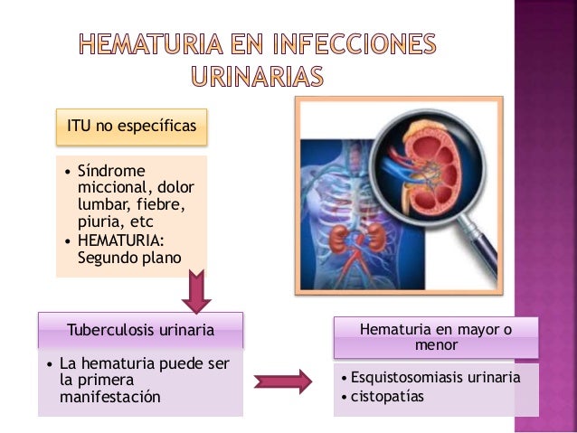 Hematuria