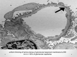 Hematuria (Renal) | PPT