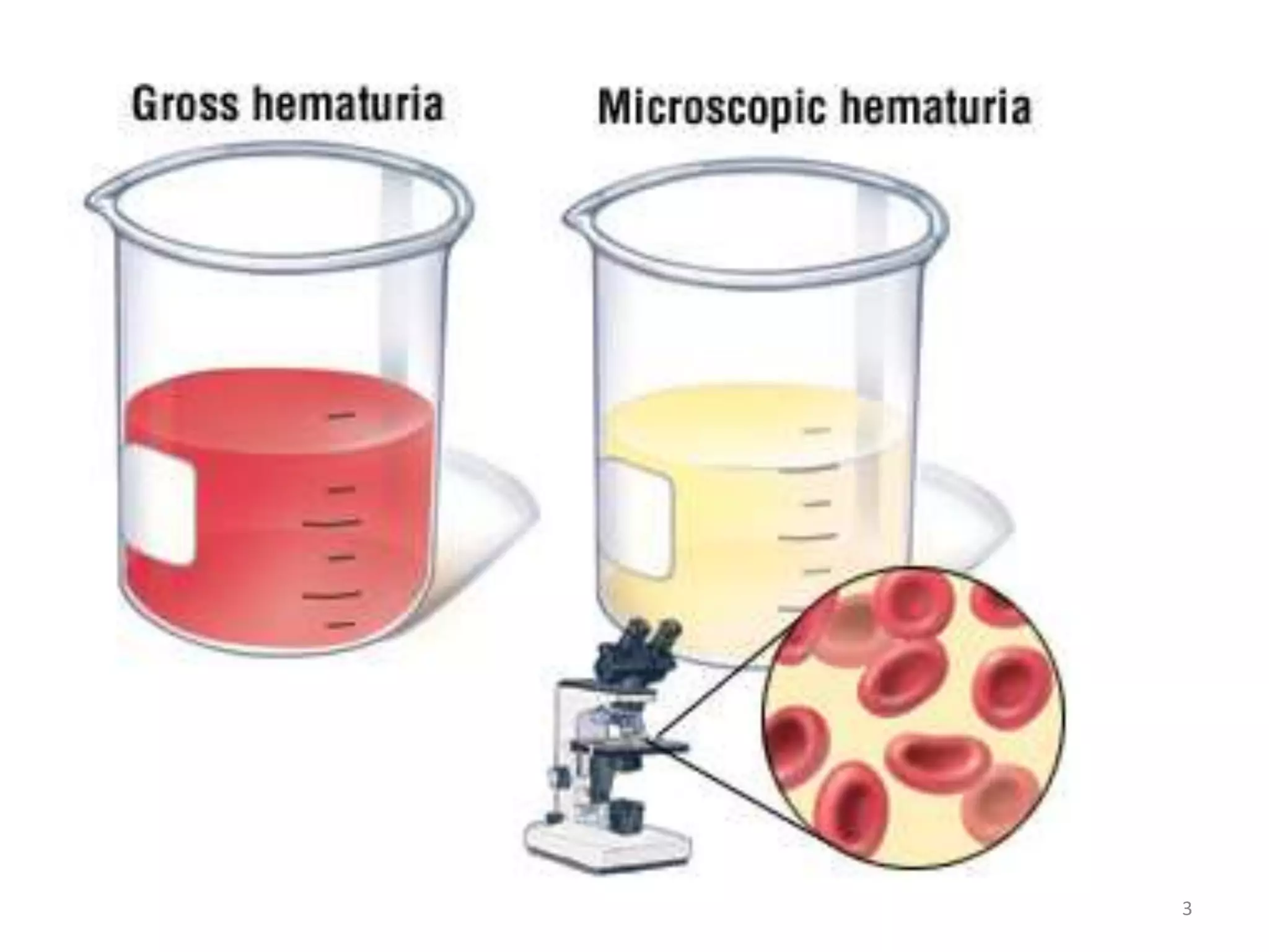 Approach to Hematuria in primary care | PPT