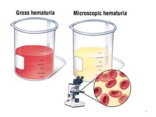 Approach to Hematuria in primary care | PPT