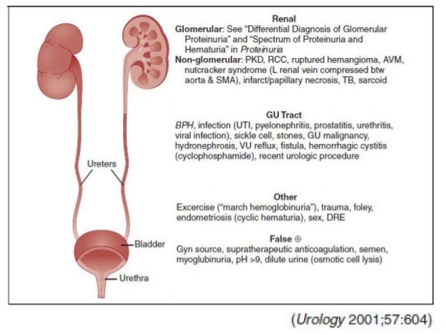 Approach to Hematuria in primary care