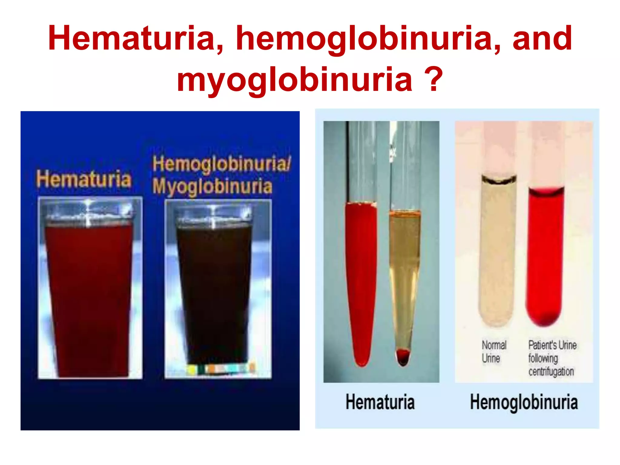 Hematuria | PPTX