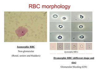 Hematuria | PPTX