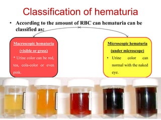 Hematuria | PPT