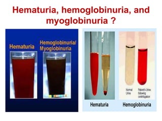 Hemoglobinuria Vs Myoglobinuria
