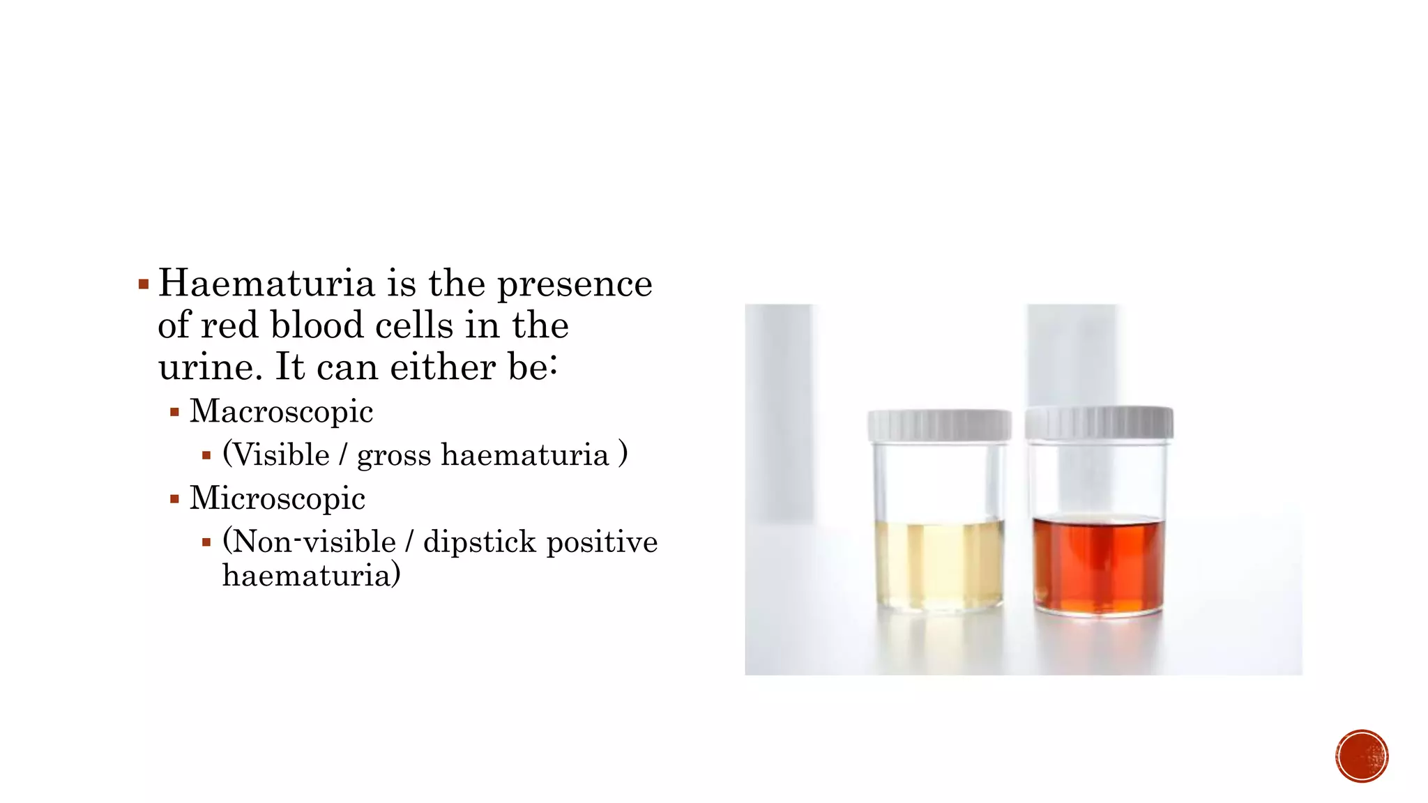 Hematuria for patient education | PPTX