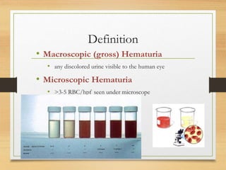 HEMATURIA.ppt