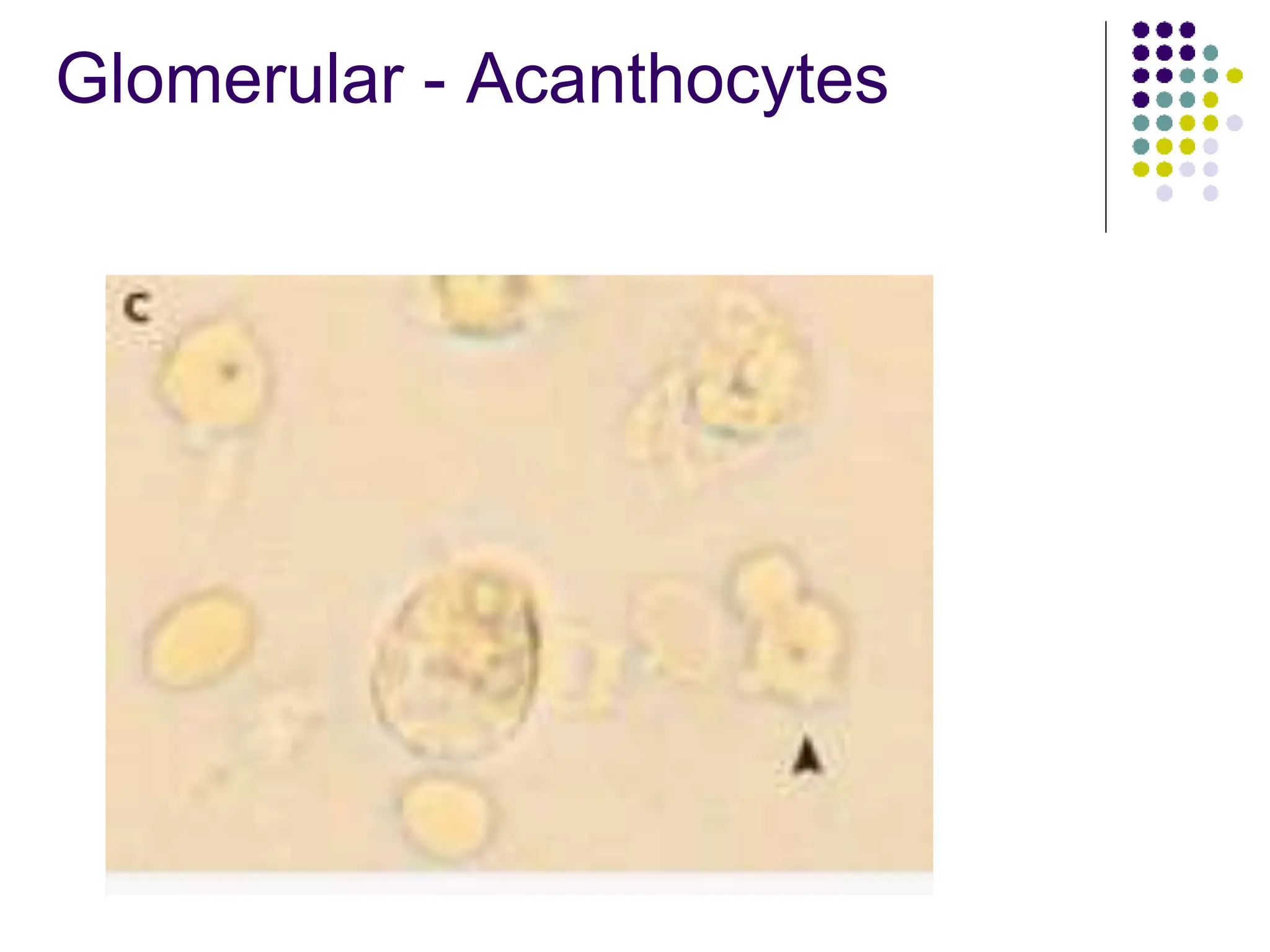 Approach to a patient with hematuria.pptx