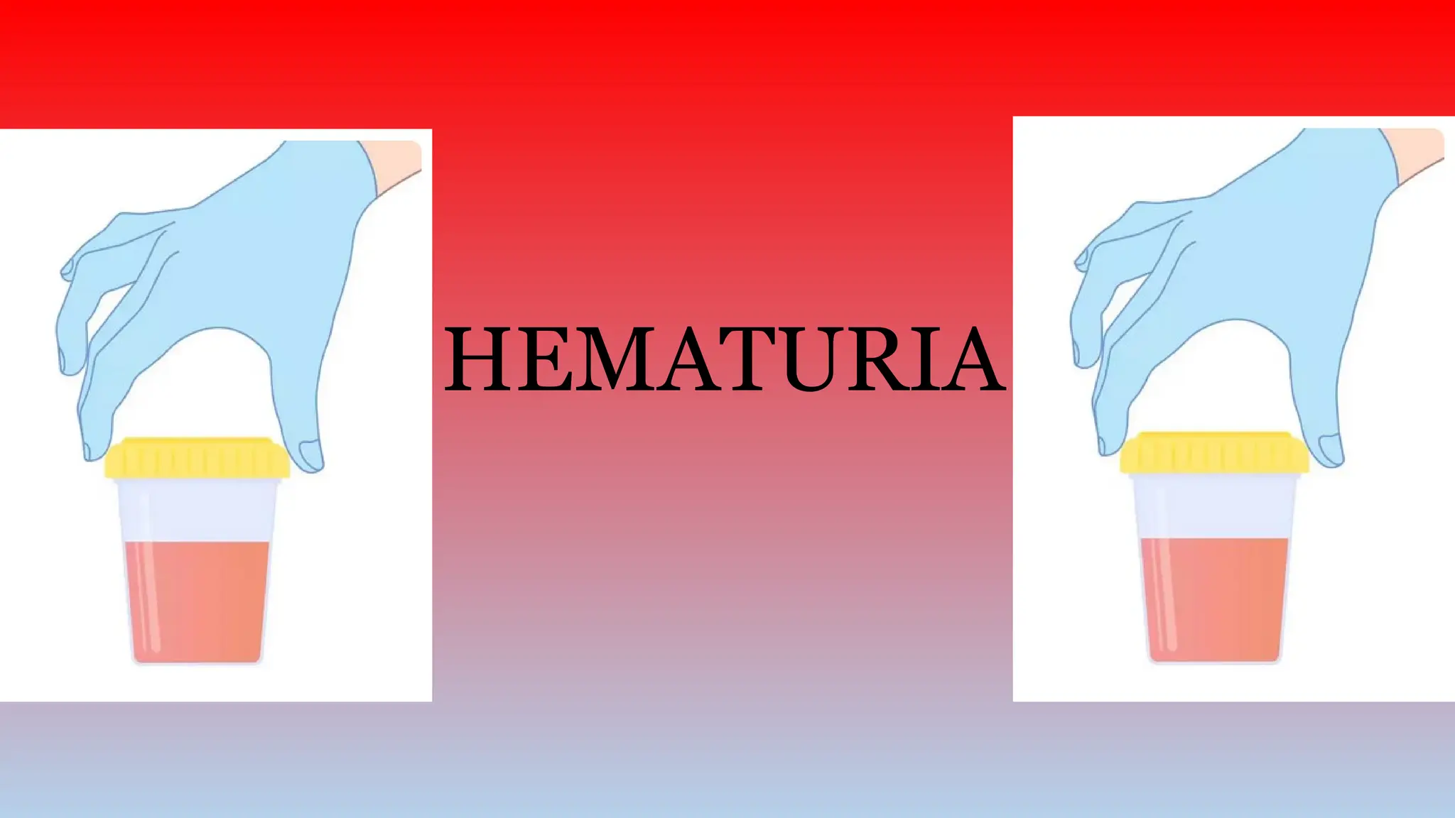 Hematuria - definition, types, risk factors, classification, etiology ...