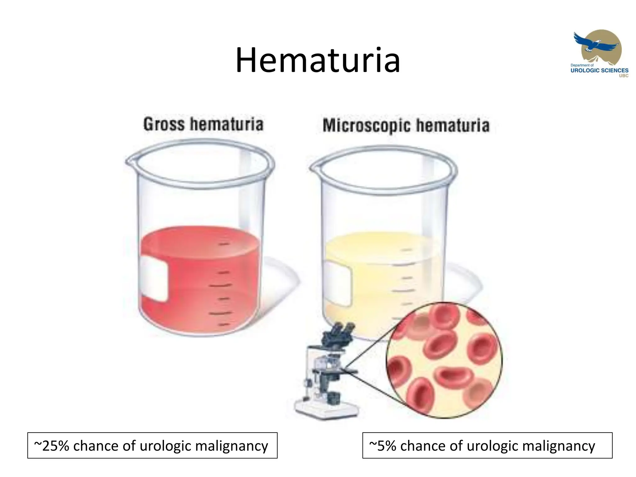 Hematuria-Med-yr-3-Lecture-2014-2015.pptx