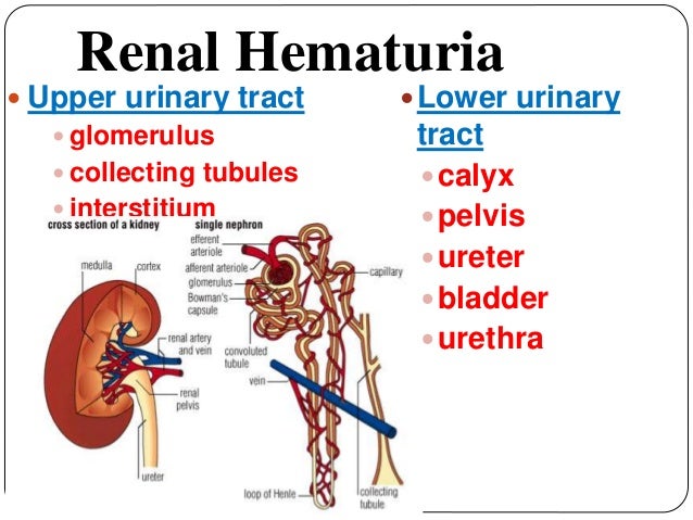 Hematuria and acute glomeulonephritis