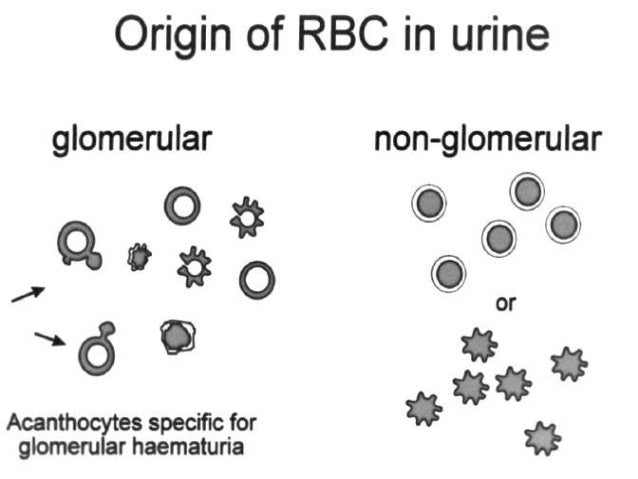 Hematuria and acute glomeulonephritis