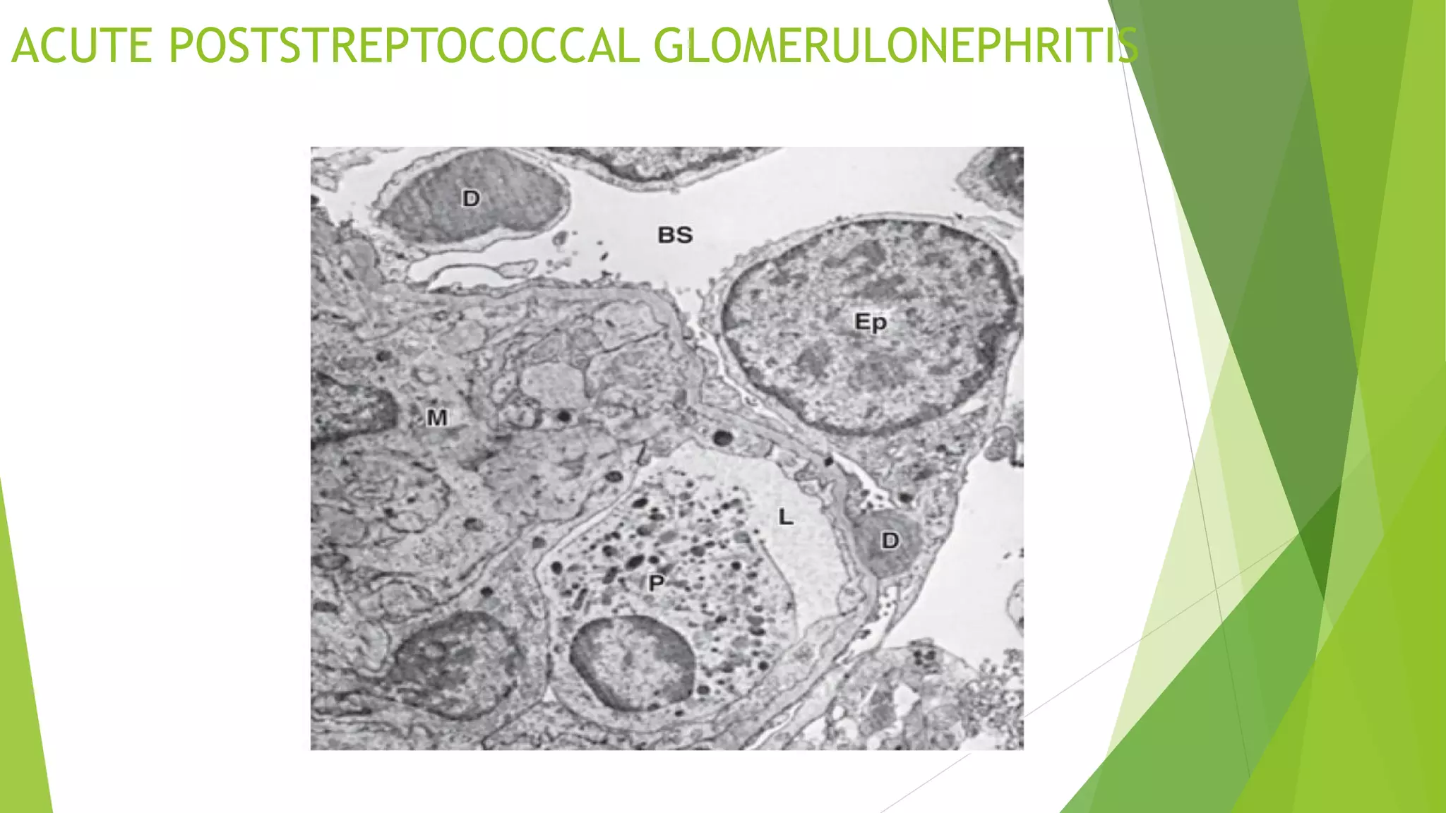 APPROACH TO HEMATURIA IN CHILDREN and APSGN | PDF