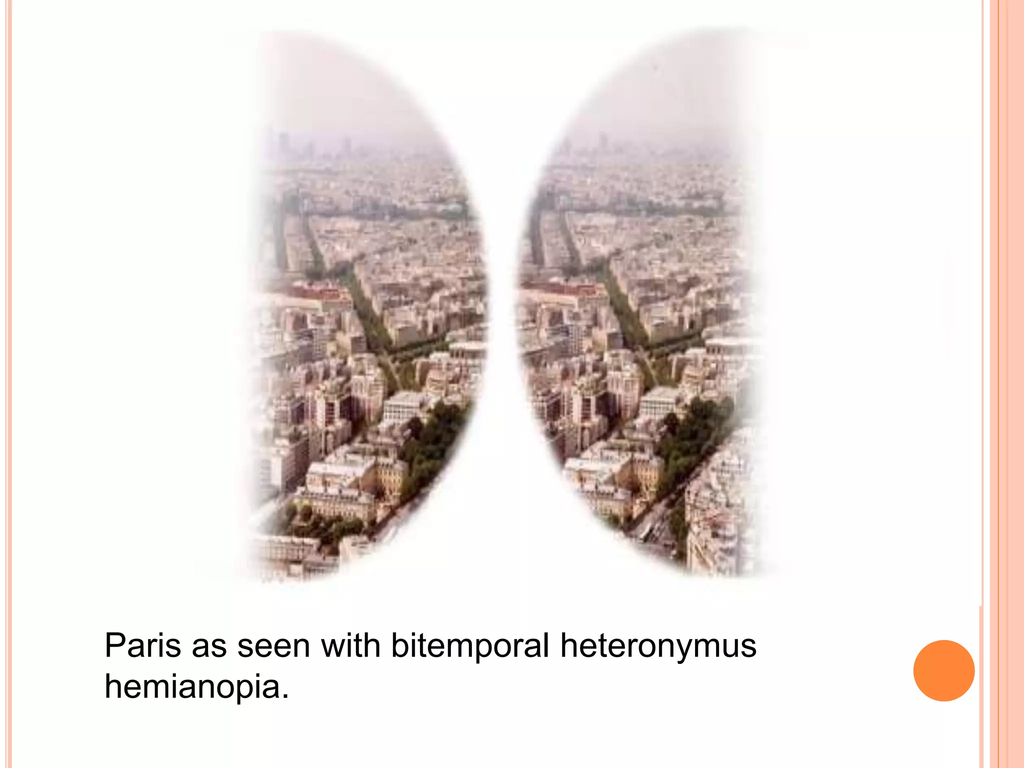 Bitemporal Heteronymous Hemianopia | PPTX