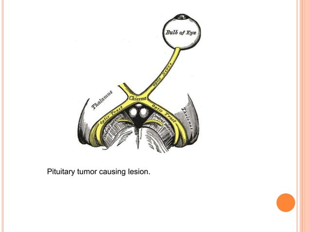 Bitemporal Heteronymous Hemianopia | PPTX | Eye and Vision Conditions ...