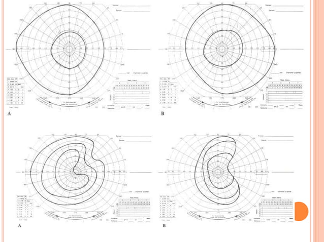 Bitemporal Heteronymous Hemianopia | PPTX | Eye and Vision Conditions ...