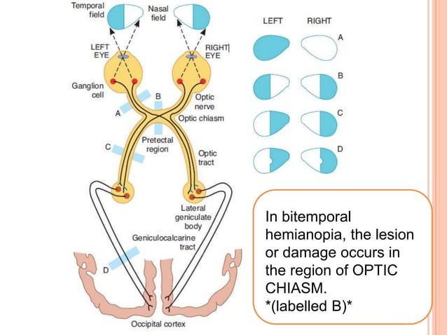 Bitemporal Heteronymous Hemianopia | PPTX | Eye and Vision Conditions ...