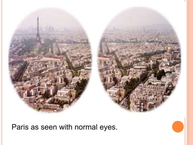 Bitemporal Heteronymous Hemianopia | PPTX | Eye and Vision Conditions ...