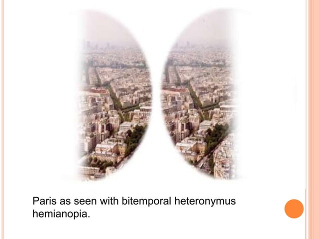 Bitemporal Heteronymous Hemianopia | PPT