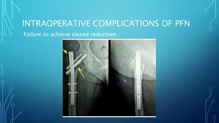 Hemiarthoplasty debate. hemiarthroplasty | PPTX